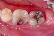 Teeth Bonding Procedures | Aesthetic Dentistry