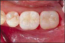 Teeth Bonding Procedures | Aesthetic Dentistry